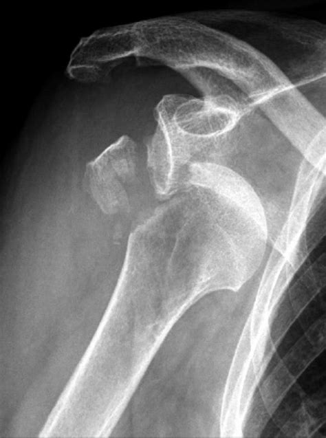 Left Humerus Fracture Kingkorean