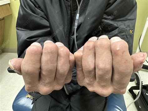 Calcinosis In Scleroderma Stock Image C060 4786 Science Photo Library