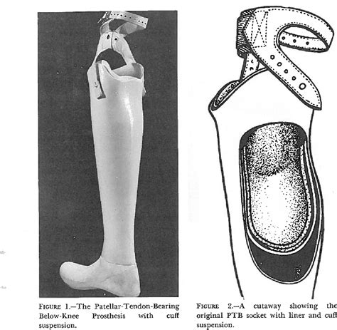 Figure 7 From Variants Of The Ptb Patellar Tendon Bearing Below Knee Prosthesis Semantic