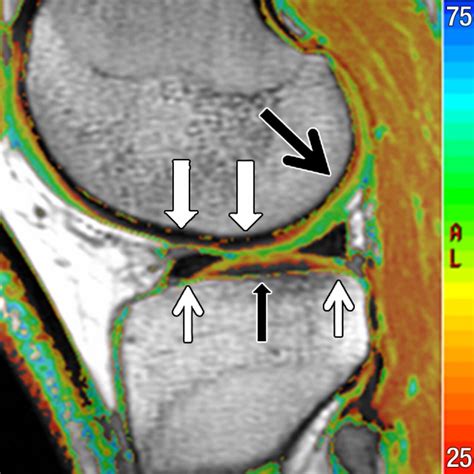 Knee Cartilage Grading Mri At Renee Andrzejewski Blog