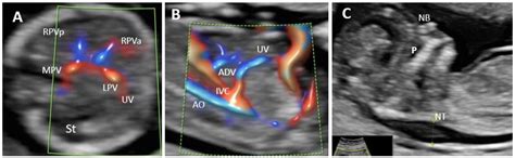 Feasibility Of Fetal Portal Venous System Ultrasound Assessment At The