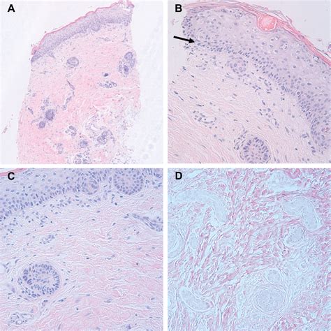Figure 2 From A Case Of Restrictive Dermopathy With Novel Zmpste24 Gene