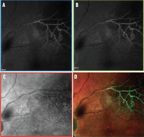 Defining Ocular Ischemic Processes An Atlas Retina Today