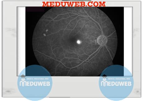 CENTRAL SEROUS CHORIORETINOPATHY CSCR Meduweb