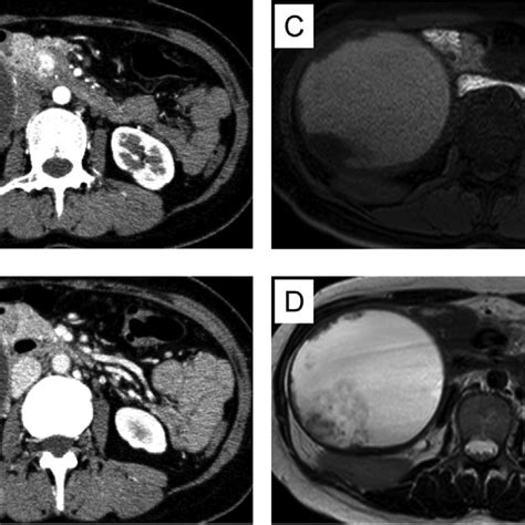 Total Reported Cases Of Isolated Enteric Duplication Cyst Download Table