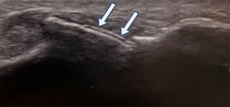 Mohammad Rafi Safi On Linkedin A Common Ultrasound Appearance Of Gout