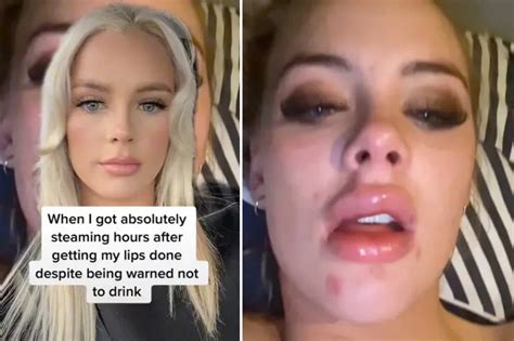 Alcohol After Botox 🍺 Botox Brow Lift