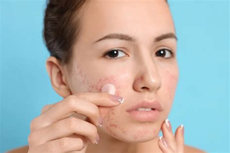 4 Rekomendasi Acne Patch Terbaik Untuk Remaja Bisa Dibeli Di Minimarket