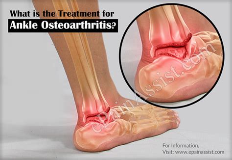 Ankle Osteoarthritis Early Onset Osteoarthritis Symptoms Causes