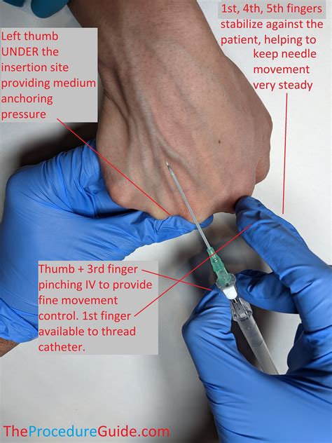 Intravenous Catheter Insertion Iv Insertion Youtube