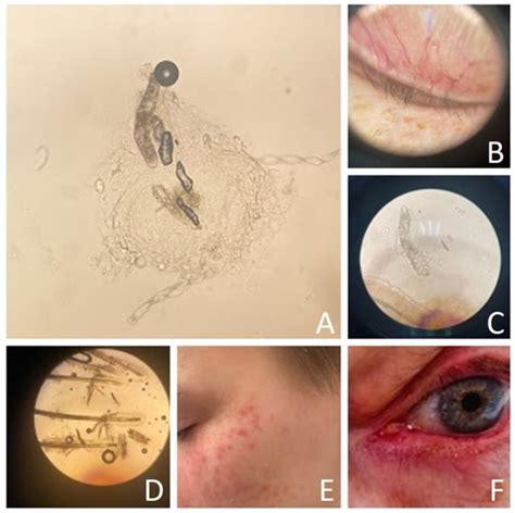 Significance Of Demodex Folliculorum And Demodex Brevis In Pathogenesis