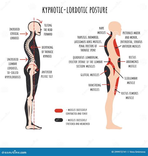 Lordotic Posture Side View Shows Hyperlordosis Deformation Spine