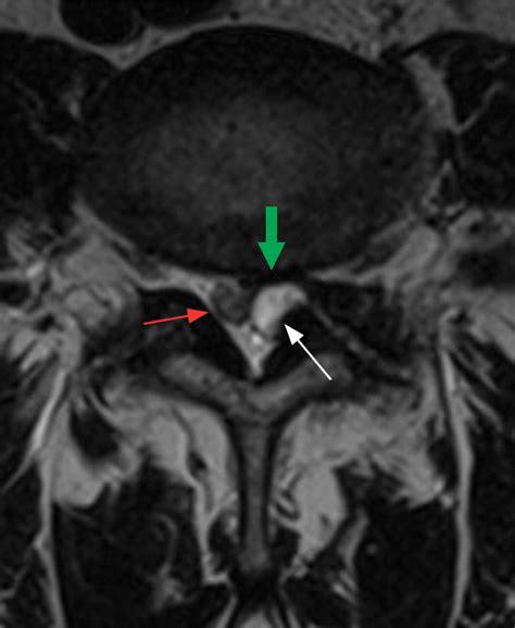 Facet Joint Hypertrophy Lumbar Spine At Steve Harwell Blog