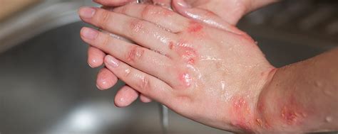 Aquagenic Pruritus What It Is And How To Find Relief