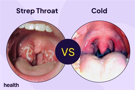 Everything You Need To Know About Strep Throat Symptoms Causes And