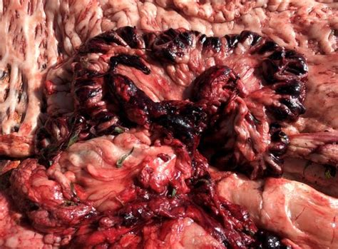 Mesenteric Artery Rupture