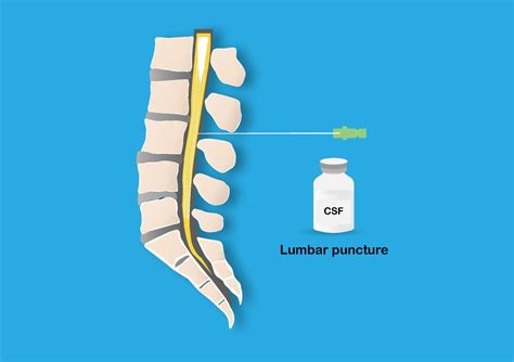 Lumbar Punción Procedimiento Ilustración 51125617 Vector En Vecteezy