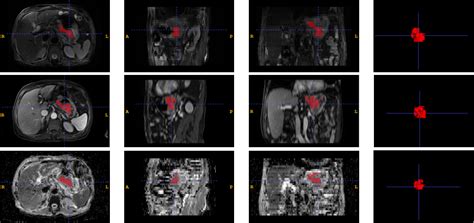 Hwa Unetr Hierarchical Window Aggregate Unetr For 3d Multimodal Gastric Lesion Segmentation