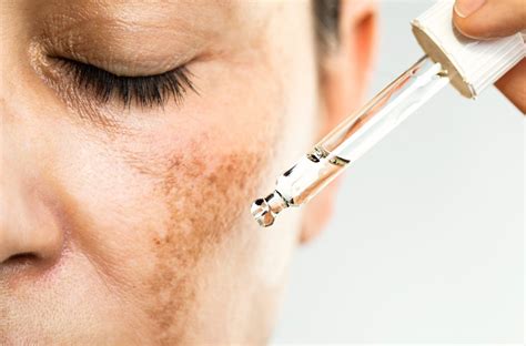 Common Hyperpigmentation Concerns Marketsmiths