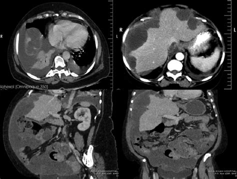 Ct Scan Of The Abdomen Revealed Multiple Subcapsular Lesion Peritoneal