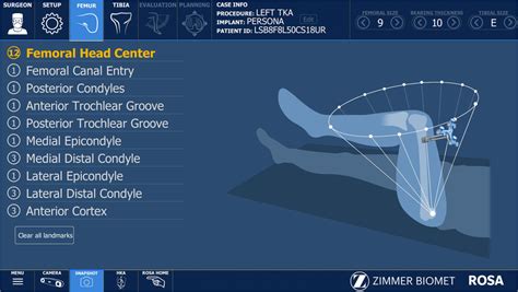 Registration Screen Displaying The Workflow For The Required Femoral