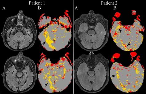 patient 1 left and patient 2 right a fluid attenuated inversion