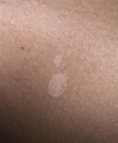 I Got These White Spots On My Chest They Are Like Circles I Have 2