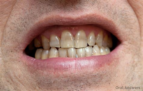 Teeth Treat Internal Tooth Whitening