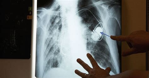 Atrial Fibrillation And Pacemaker Effectiveness And Risks