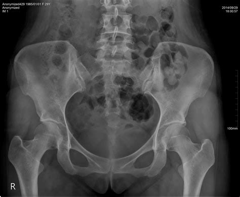 Pelvis Ap Digital X Ray Image Made By A Cr Unit How To Make Image