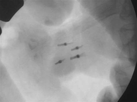 The Clips On The Margin Of The Tumor Were Visible Under Intraoperative