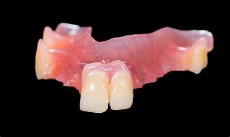Flipper Partial Denture Direct Dental Prosthetics