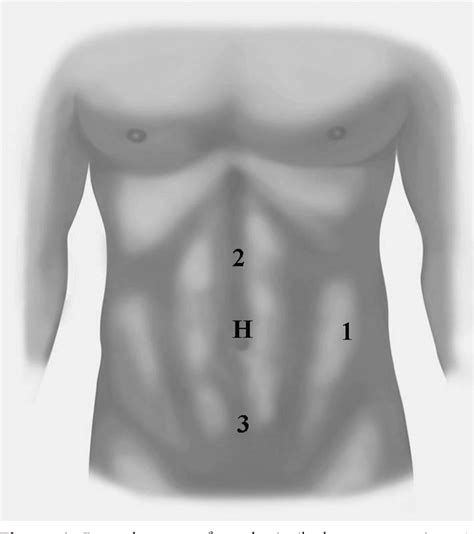 Figure 1 From Robot Assisted Laparoscopic Ileal Ureter Semantic Scholar