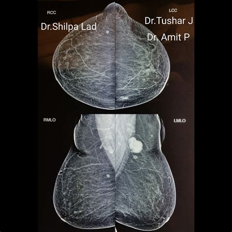 Reduction Mammoplasty With Excision By Stereotactic Localization
