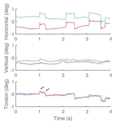 Example Of Eye Movements During Attempted Fixation Of A Small Target