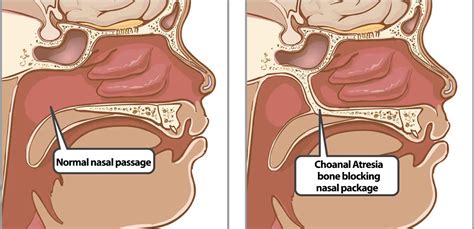 Choanal Atresia Clinical Features And Treatment