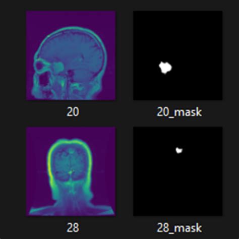 Brain Tumor Classification 2d Kaggle