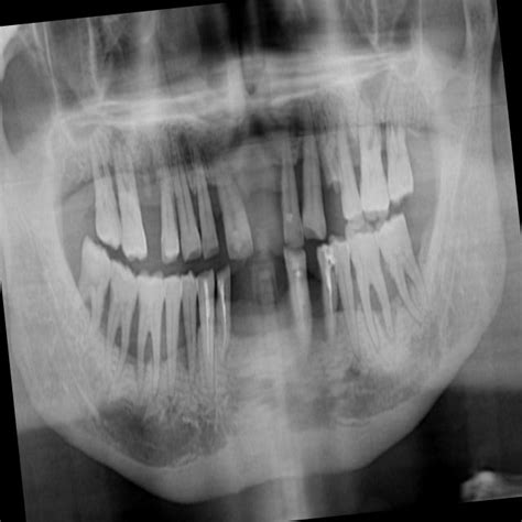 Demo Object Detection Dataset And Pre Trained Model By Teeth Problem