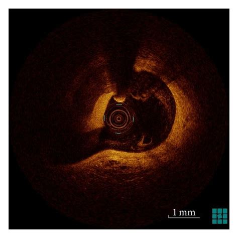 A Shows A Cross Sectional Ivus Image With Visible Calcification And Download Scientific