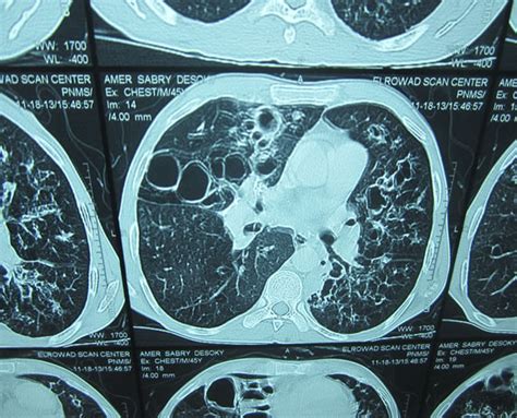 Impact Of Cystic Versus Cylindrical Types Of Bronchiectasis On Pulmonary And Cardiac Functions