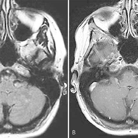Axial Flair Image A Multiple Punctate And Linear Flair Hyperintense Download Scientific