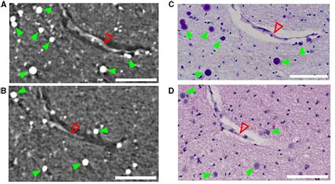 Frontiers Distribution Of Corpora Amylacea In The Human Midbrain Using Synchrotron Radiation