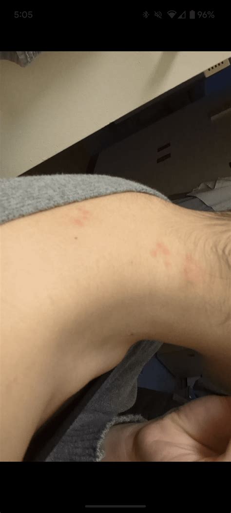 Bed Bugs Maybe Rbugbites