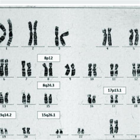 Karyotype Showing A Woman Abnormality In Chromosomes Of Pair 8 Of The