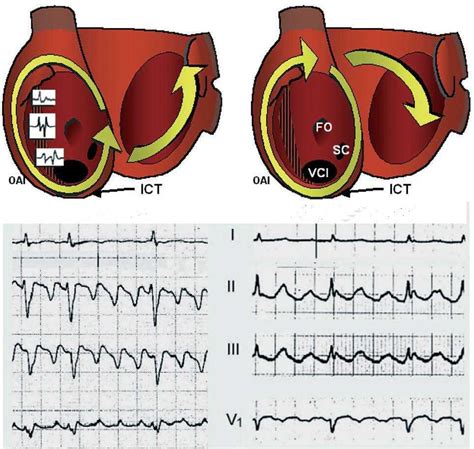 Flúter Auricular Perspectiva Clínica Actual Revista Española De