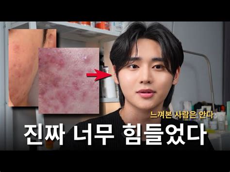 진짜 너무 힘들었다 여드름 때문에
