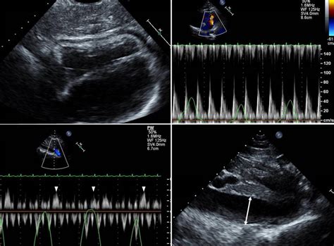 Transthoracic Echocardiography Findings Of Her Second Emergency
