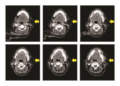 Ct Scans Showed A Low Density Homogeneous Capsulated Mass With Sharp Download Scientific