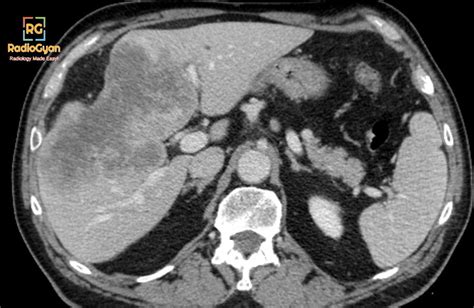 Cholangiocarcinoma