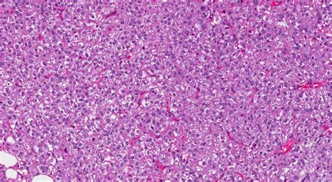 Epithelioid Angiomyolipoma Ottawa Atlas Of Pathology